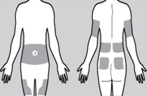 4 Tips for Infusion Set and Sensor Site Rotations - The LOOP Blog